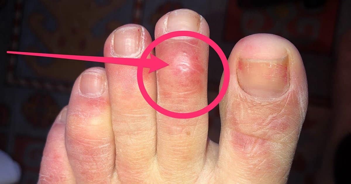 "COVID-Toe," A New And Strange Symptom Of Coronavirus Infection - Elite ...